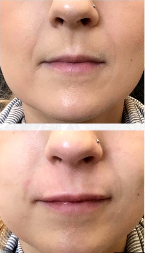 Dermal Fillers | Solace Wellness Center & MedSpa | Tewksbury, MA