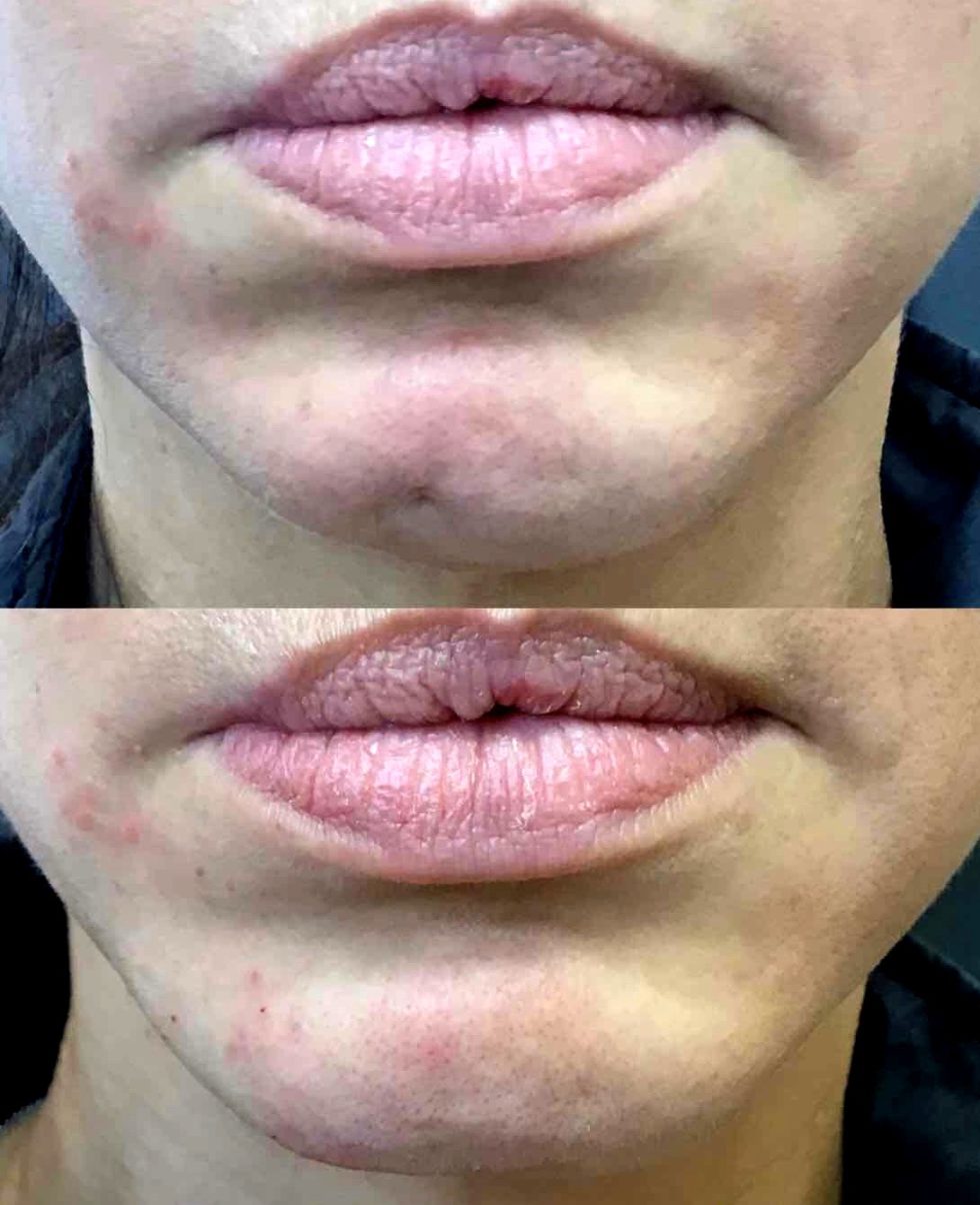 Dermal Fillers | Solace Wellness Center & MedSpa | Tewksbury, MA